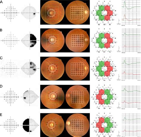 Representative Visual Field Left Optical Coherence Tomography Download High Resolution