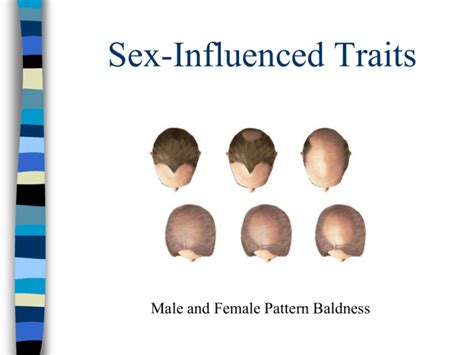 Sex Influenced Traits Pattern Baldness Genetics