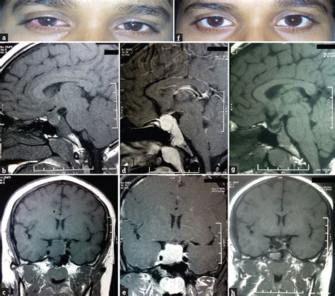 Prolactinoma Presenting As Short Lasting Unilateral Neuralorm Headache Attacks With