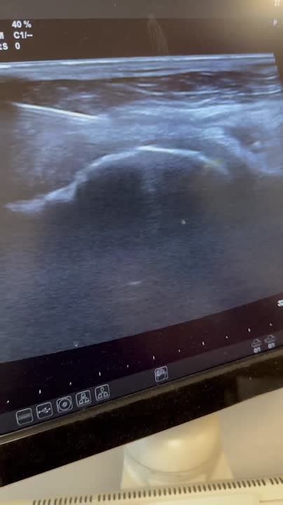 Mustafa Doğukan Aydemir On Linkedin Shoulder Subacromial Injection💉