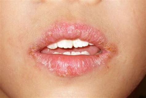 Angular Cheilitis Photos