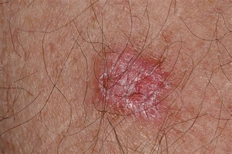 Basal Cell Carcinoma On A Mans Arm Stock Image C0585498 Science Photo Library