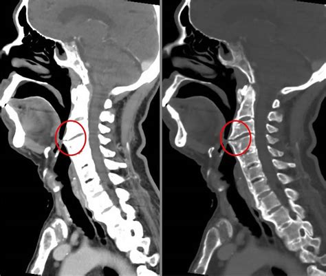 Diffuse Idiopathic Skeletal Hyperostosis Hyperostosis Frontalis Interna And Infantile Cortical