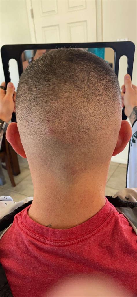 Progress Photos Hmr 35 Month Update Rhairtransplants