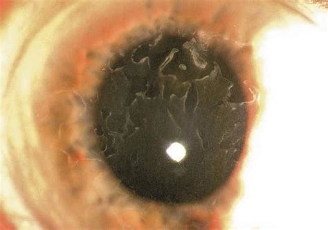 Corneal Epithelial Dystrophy