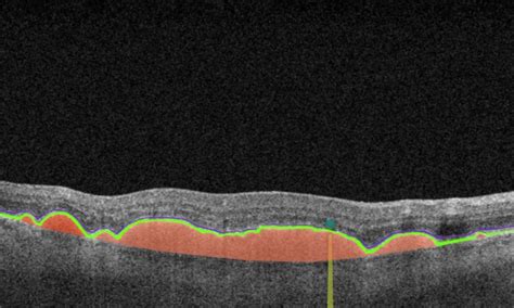 Can You Guess The Disease By Looking At The Oct Scans Leave Your Answer In The Comments The