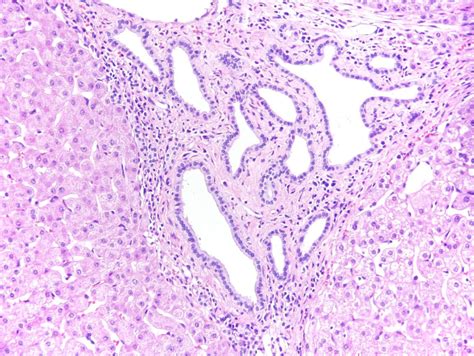 Bile Duct Hamartoma Histology