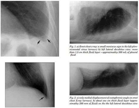 Chest X Ray Pleural Effusion Epomedicine