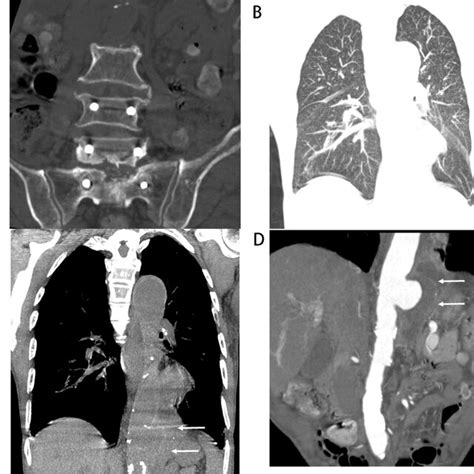 Iliopsoas Abscess Associated With Tuberculous Aortic Aneurysm Patient