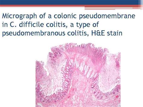 Clostridium Difficile Micropia Nl En Псевдомембранозный колит
