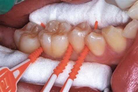 Gv Blacks Classification Of Dental Caries Explained From Basics