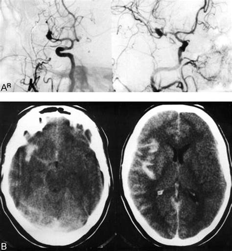 Active Bleeding From Ruptured Cerebral Aneurysms During Diagnostic