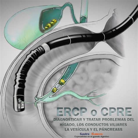 Endoscopias Y Colonoscopias Gastro Avances Precio De Jornada Ercp O Cpre Todo Junio ¿ QuÉ Es