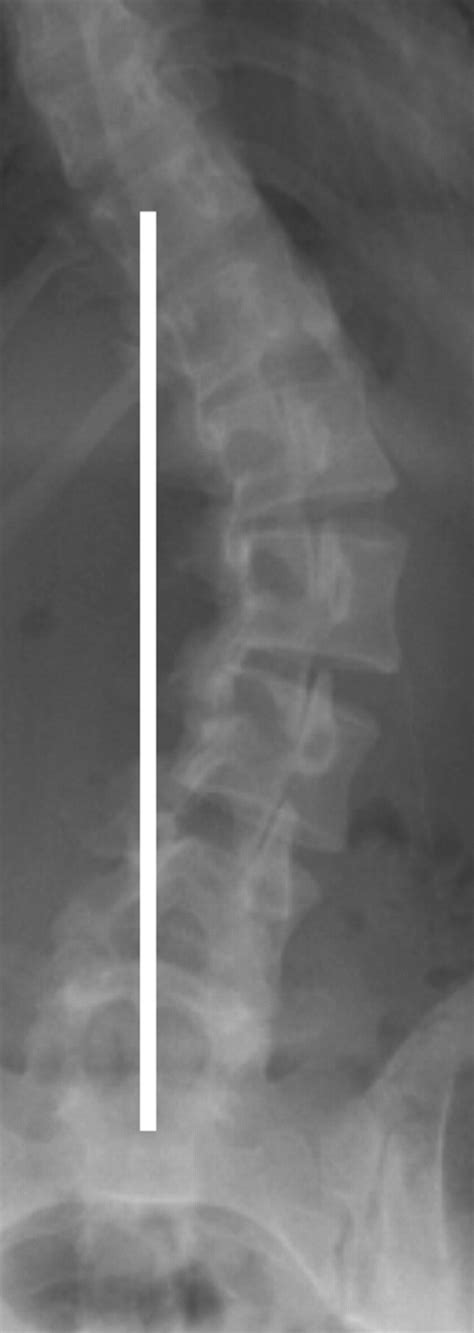 Radiographic Evaluation Of Scoliosis Review Ajr