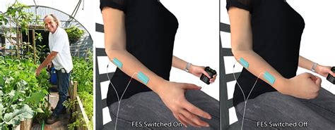 Functional Electrical Stimulation Rehab4u