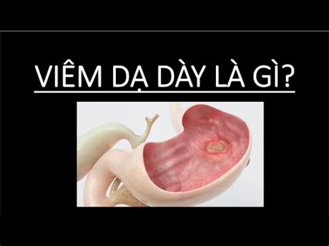 Viêm dạ dày là gì Nguyên nhân triệu chứng và cách điều trị viêm dạ dày YouTube