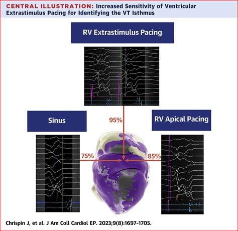 Association Of Sinus Wavefront Activation And Ventricular Extrastimuli Mapping With Ventricular