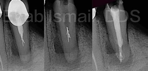 Retrieval Or Bypassing Of Broken Instrumentsfiles Socal Root Canal Retrieval Or Bypassing Of Broken Instrumentsfiles Socal Root Canal