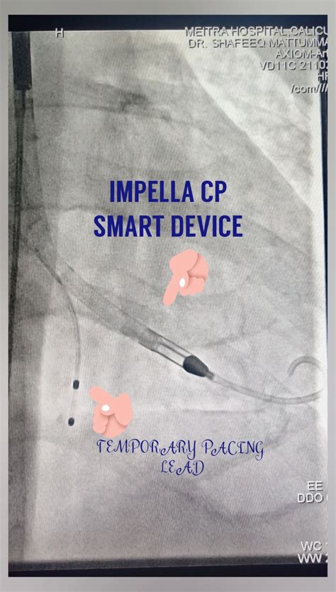 Shanid P M On Linkedin Lm Lad And Rca 1 Impella Cp 2 Rotablation 3