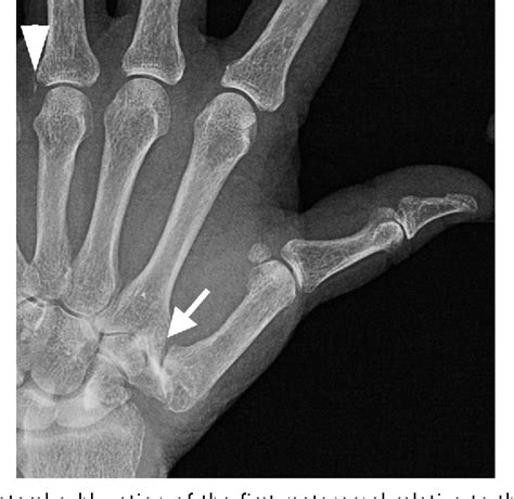 Scleroderma Hands Xray