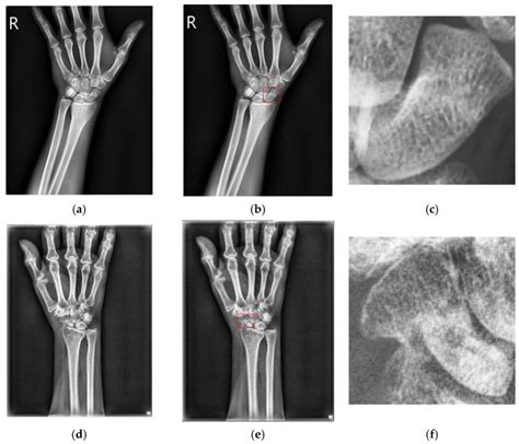 Scaphoid Fracture Detection By Using Convolutional Neural Network Pmc