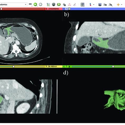 a volumetric manual segmentation performed with 3d slicer software