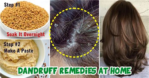 How To Prevent Dandruff Ask The Nurse Expert