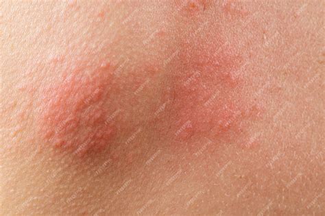 Premium Photo Chickenpox Rash Shingles Varicella Zoster Virus Skin