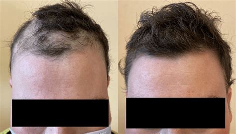 Patchy Alopecia Areata In A 42 Year‐old Female Refractory To Pulse