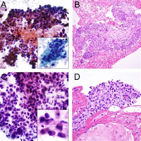 Chondroblastoma Of The Proximal Humerus Plain Radiograph Showing Download Scientific Diagram