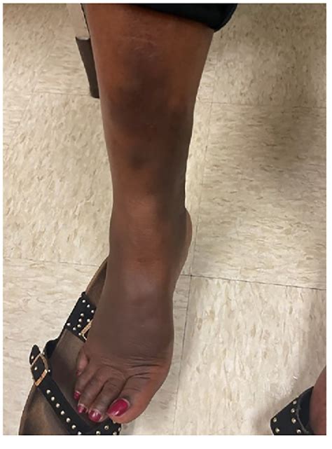 Pretibial Myxedema In A Patient With Hiv And Hypothyroid To Hyperthyroid Transformation