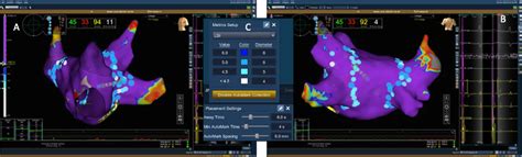 Electroanatomical Map Of La And Pv After Continuous Circular Rf