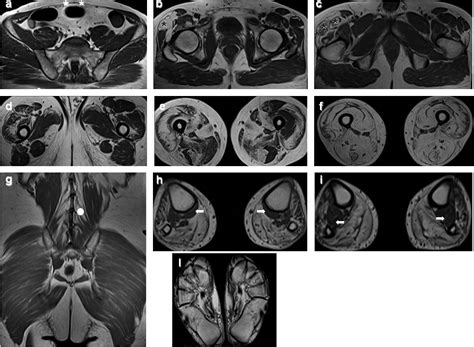 Myotonic Dystrophy Type 1 And De Novo Fshd Mutation Double Trouble A