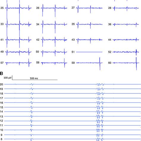 Examples Of Surface Emg Signals Recorded Using The Two Electrode Download Scientific Diagram