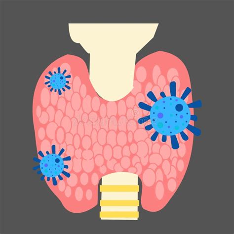 Thyroid Infection Thyroiditis Thyroid Gland Inflammation Endocrine