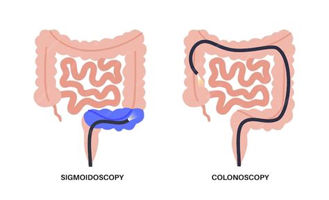 Premium Vector Colonoscopy And Sigmoidoscopy Test Examination And