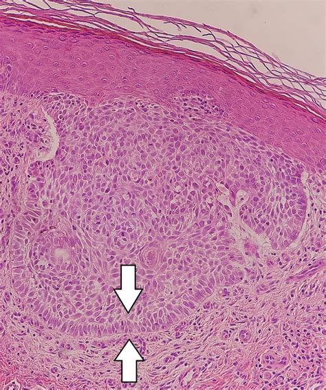 Carcinoma Basocelular Concise Medical Knowledge