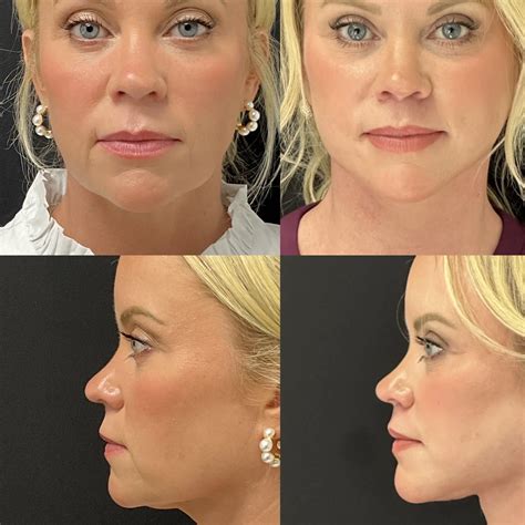 Lip Lift Surgery With Facelift Types Fat Grafting And Recovery Dr