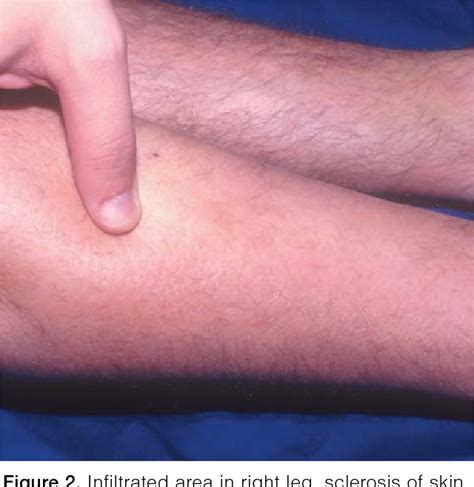 [pdf] Eosinophilic Fasciitis Shulman Syndrome Semantic Scholar