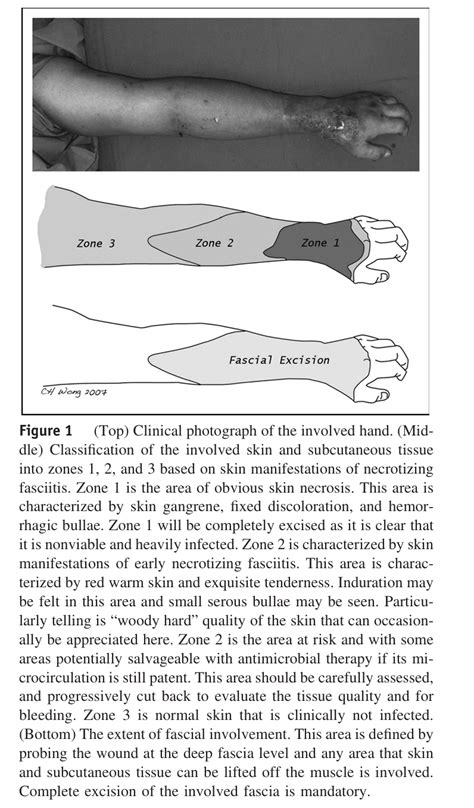 Upper Limb Nec Fasc On The Rise 3 Necrotising Fasciitis Diagnoses