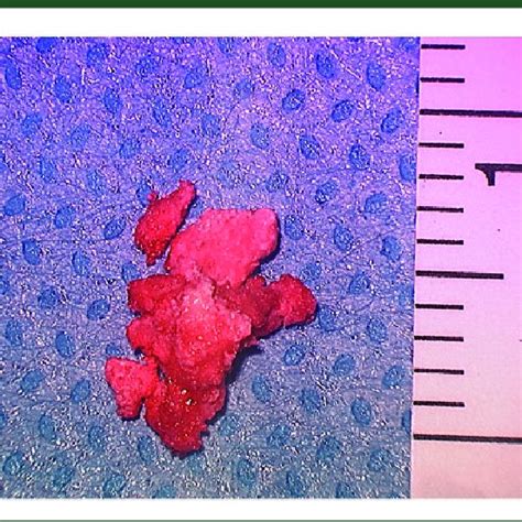 Mupparapus Classification Of Transmigrated Mandibular Canines 22