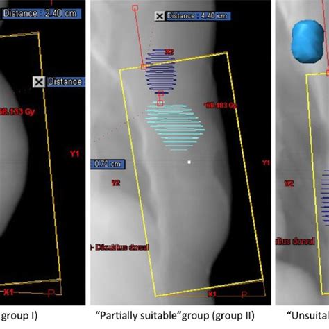 Anatomic Boundaries Of The Ipsilateral Breast And Axillary Lymph Node Download Table