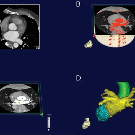 segmentation of a computed tomography ct dataset for image