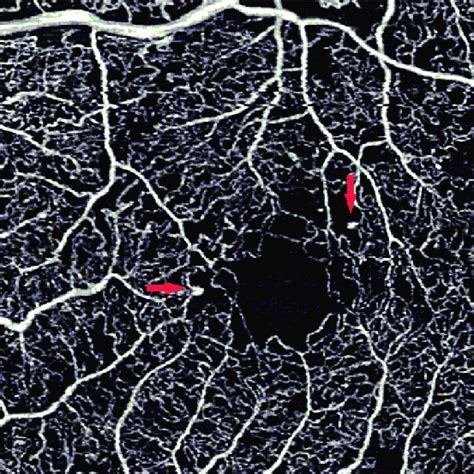A 3 Mm × 3 Mm Octa Scan From A Diabetic Patient Demonstrating Download Scientific Diagram