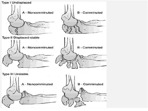 Mayo Classification For Olecranon Fractures Adapted From