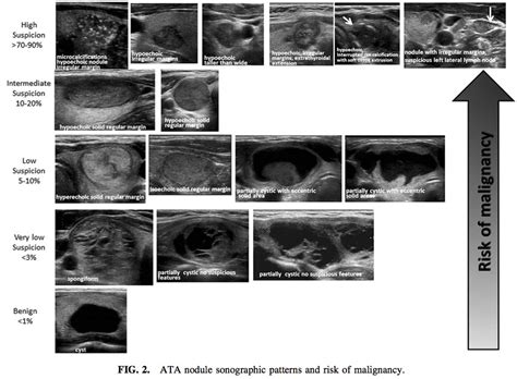 Thyroid Nodule Guidelines