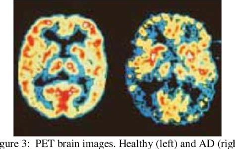 Figure 1 From Multimodal Feature Extraction For The Diagnosis Of Alzheimers Disease Semantic