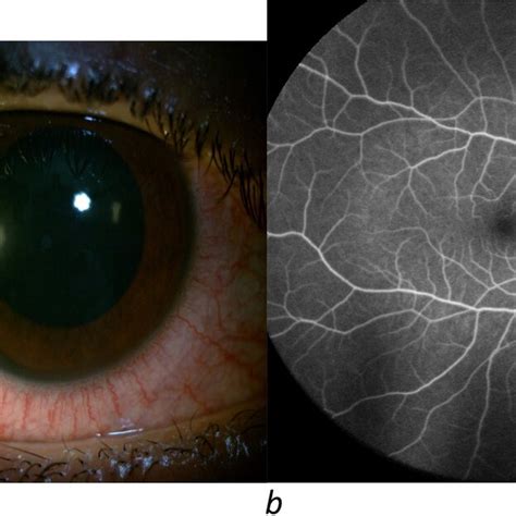 The Slit Photo Of The Right Eye Shows Ciliary Injection A Download Scientific Diagram