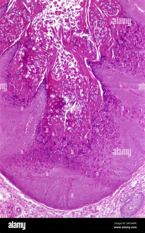 Molluscum Contagiosum Light Micrograph Of A Section Through Human Skin