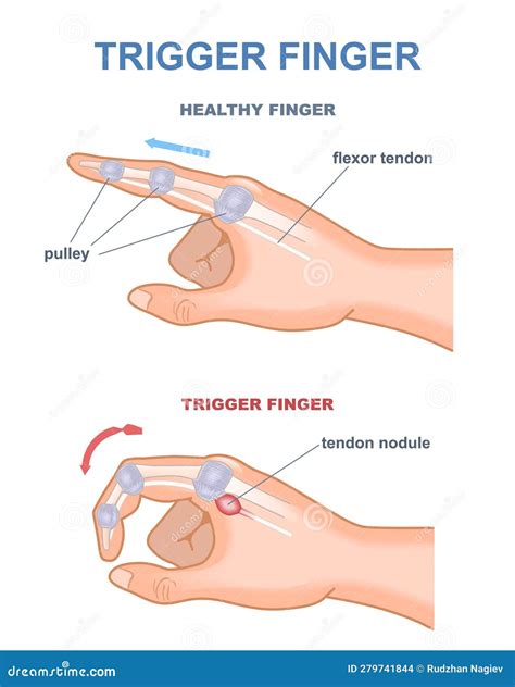 Trigger Finger Diagram Stock Illustration Illustration Of Bent 279741844